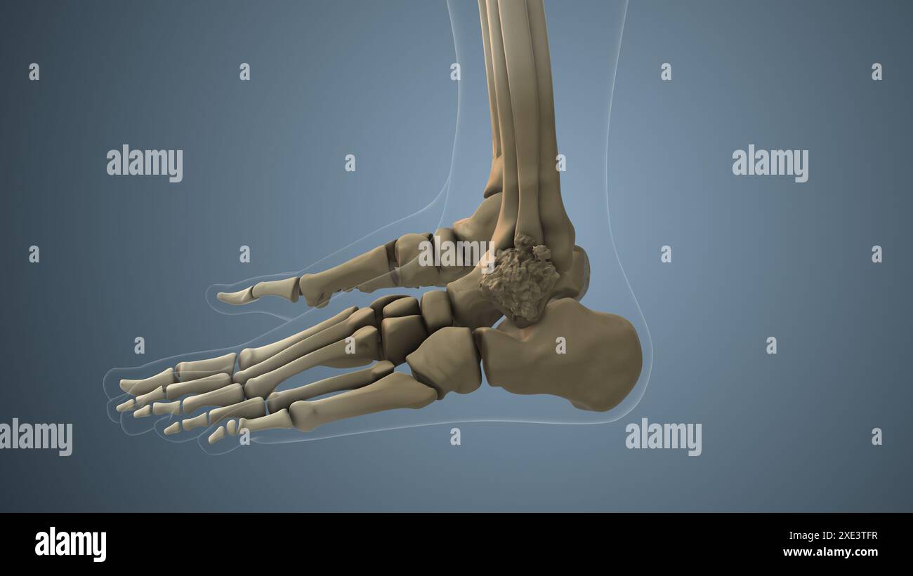 Cancer du pied Banque de photographies et d’images à haute résolution ...