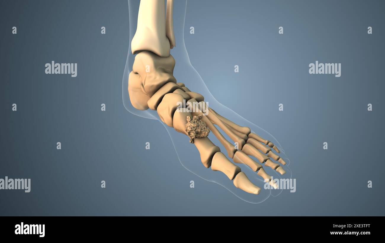 Cancer du pied Banque de photographies et d’images à haute résolution ...