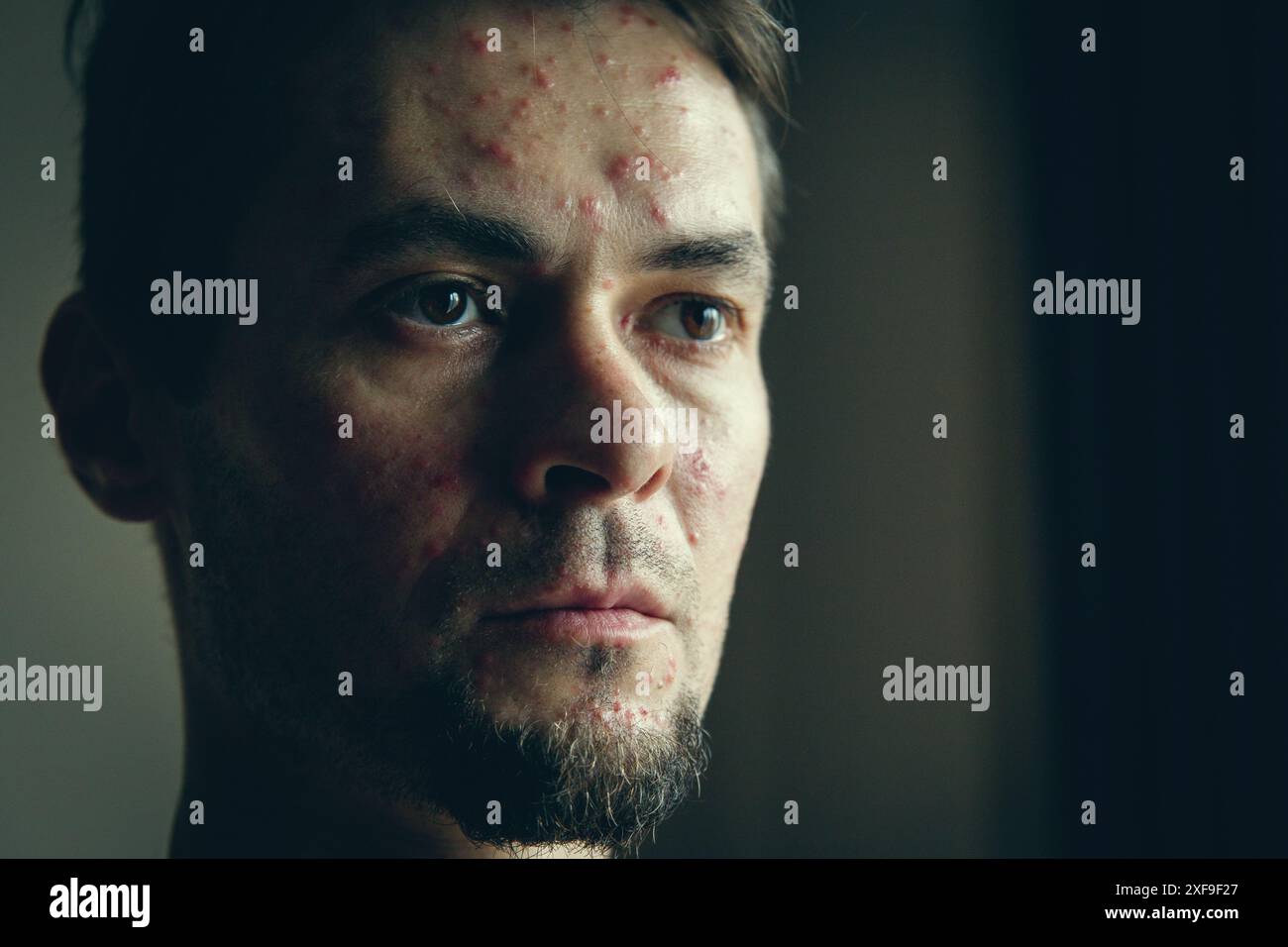 Portrait d'un homme adulte avec une éruption cutanée sur le visage sous ...