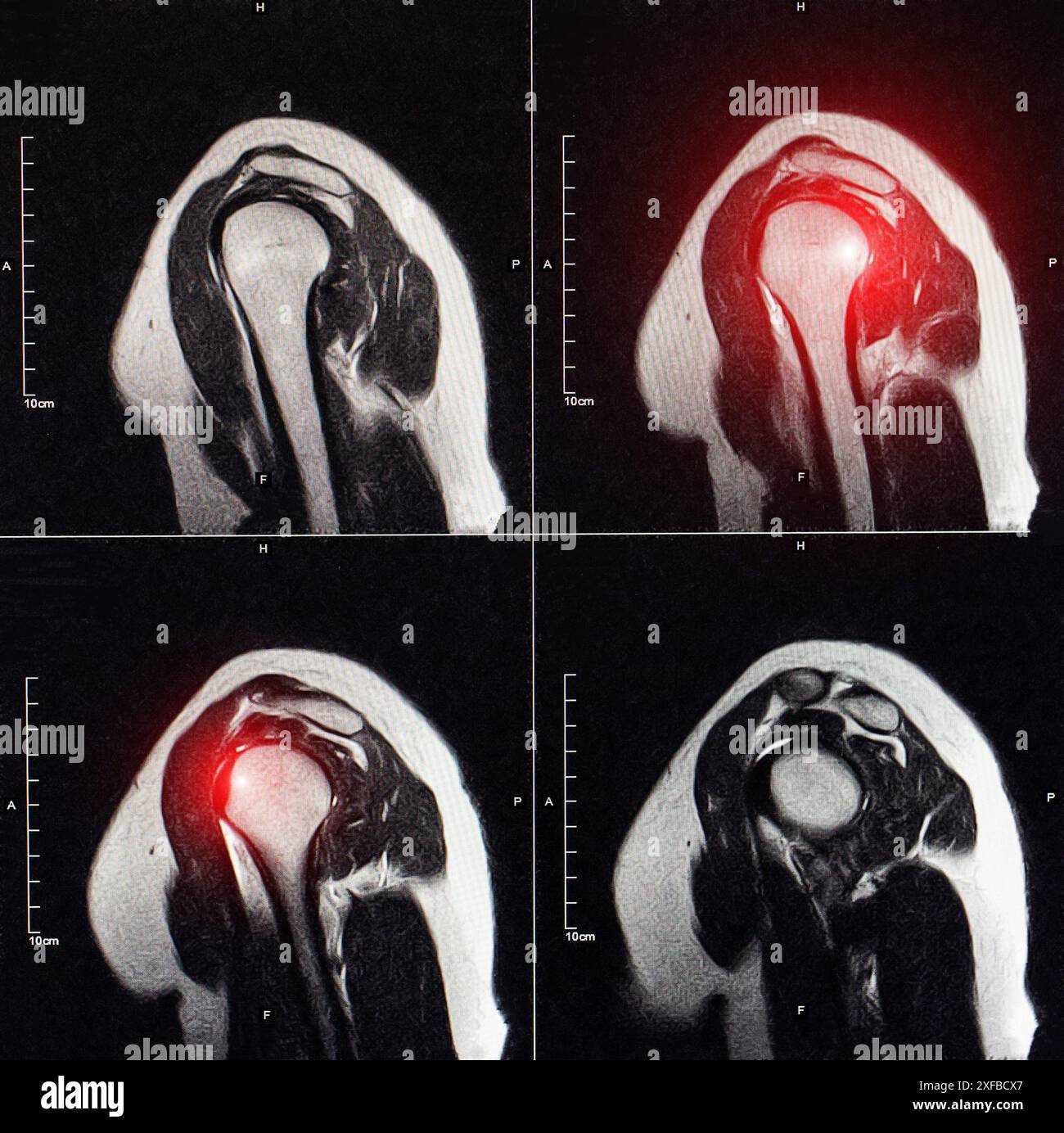 Imagerie IRM de l'articulation de l'épaule après fracture et luxation ...