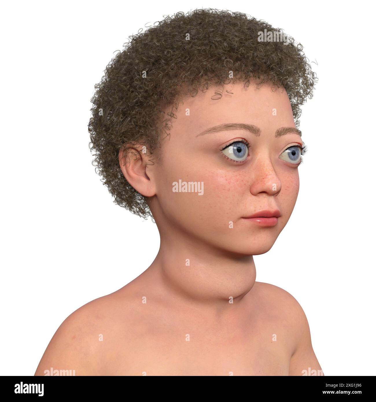 Illustration d'un enfant atteint de la maladie de Basedow, provoquant ...