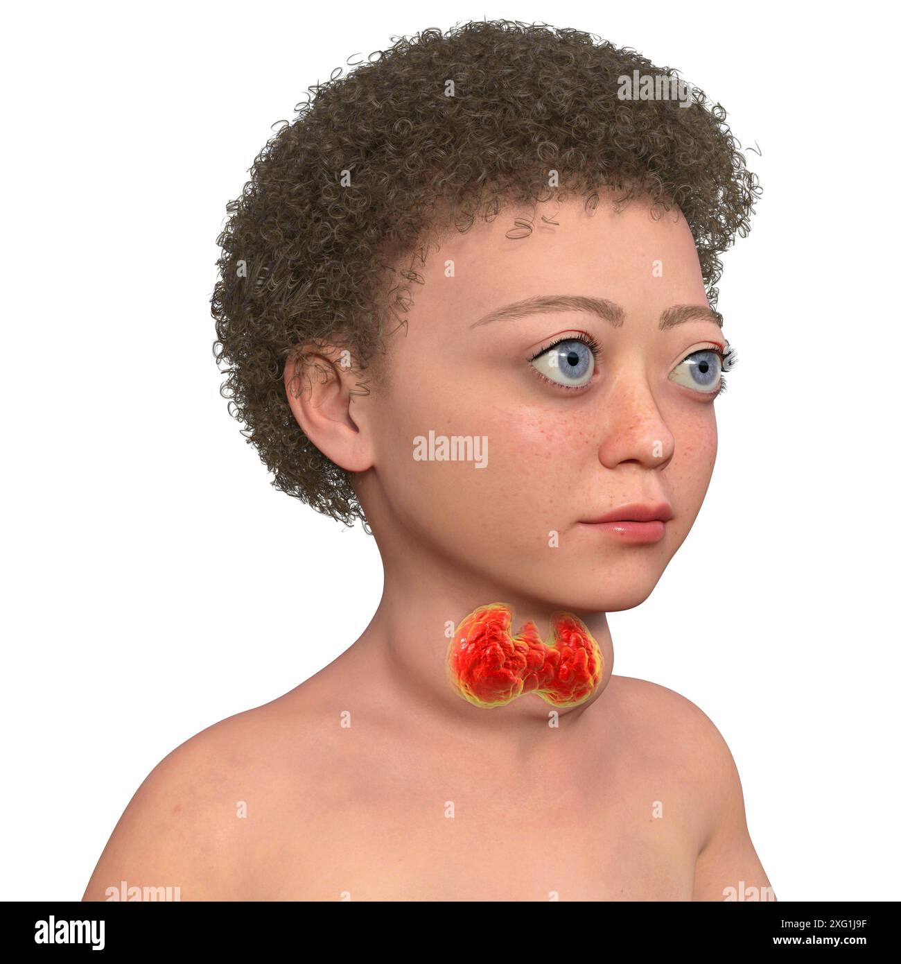 Illustration d'un enfant atteint de la maladie de Basedow, provoquant ...