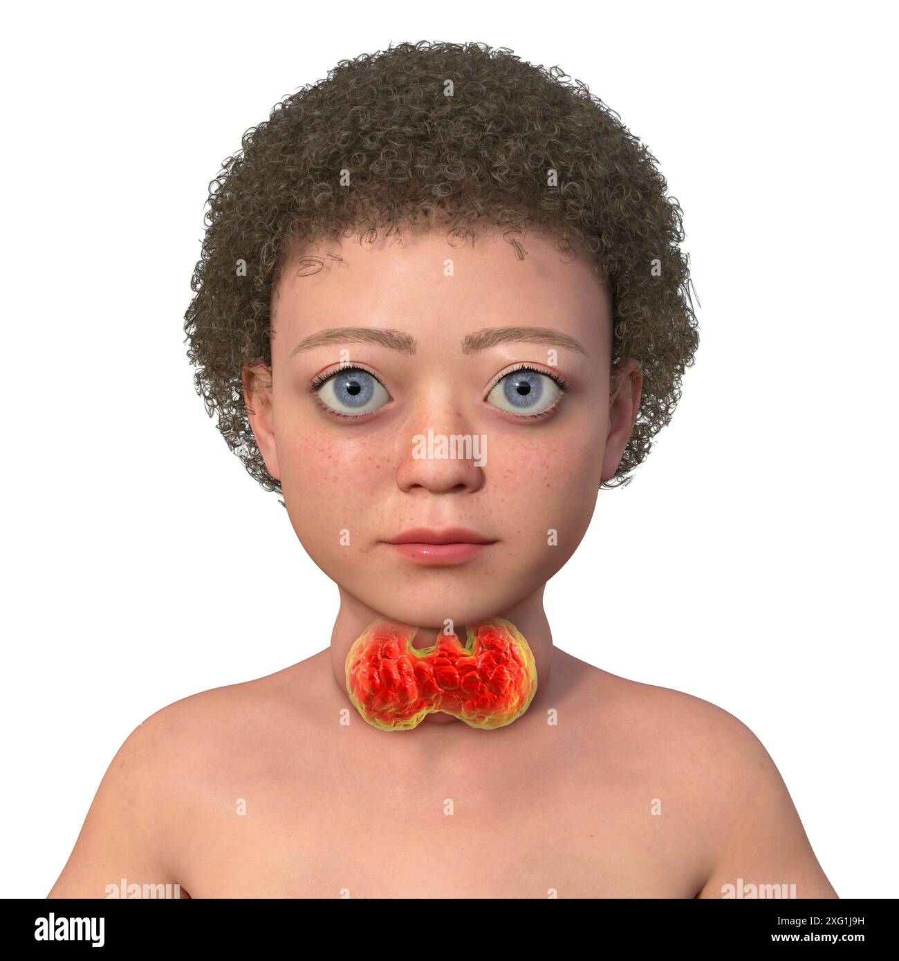 Illustration d'un enfant atteint de la maladie de Basedow, provoquant ...