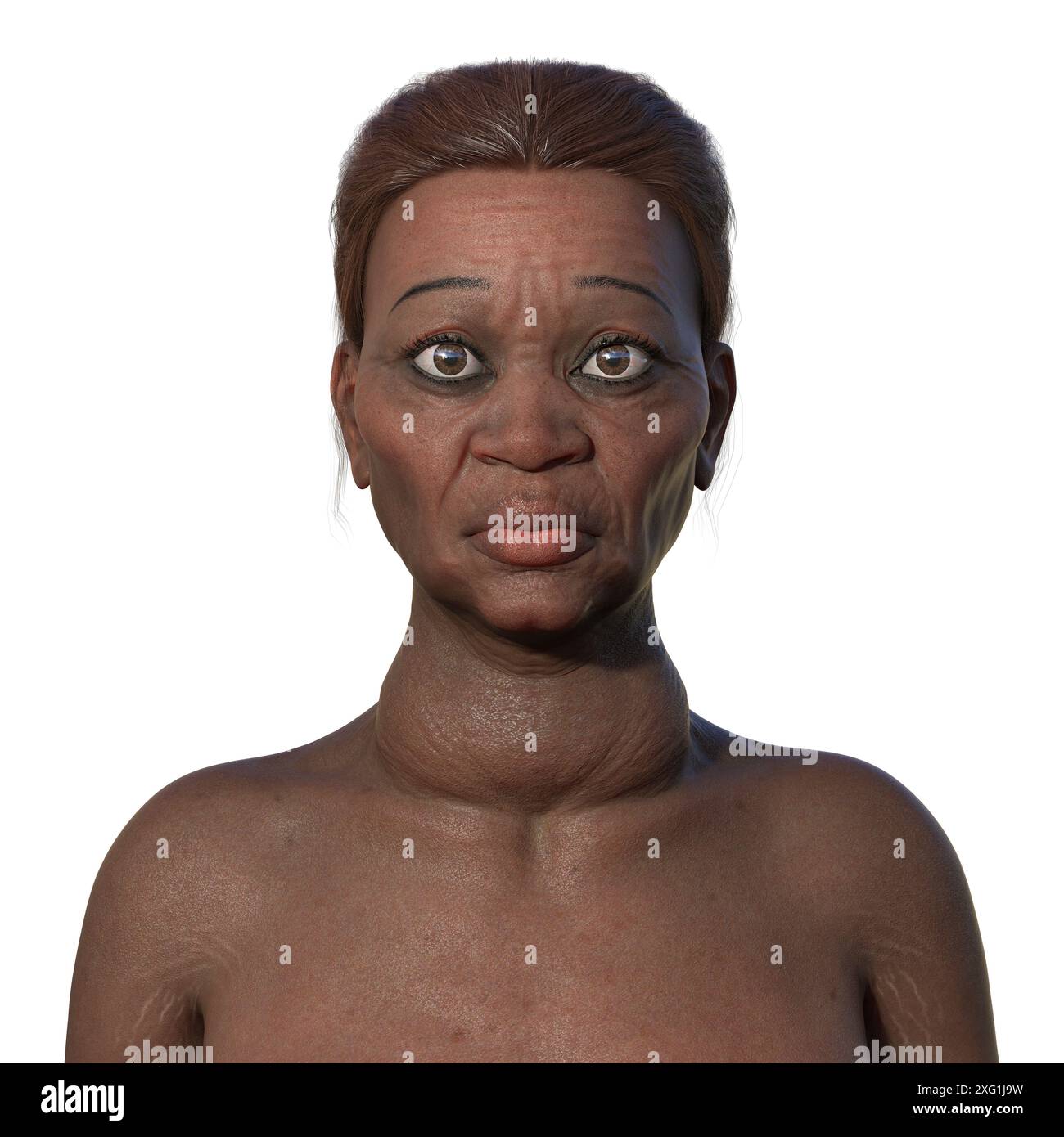 Illustration d'une femme âgée atteinte de la maladie de Basedow ...