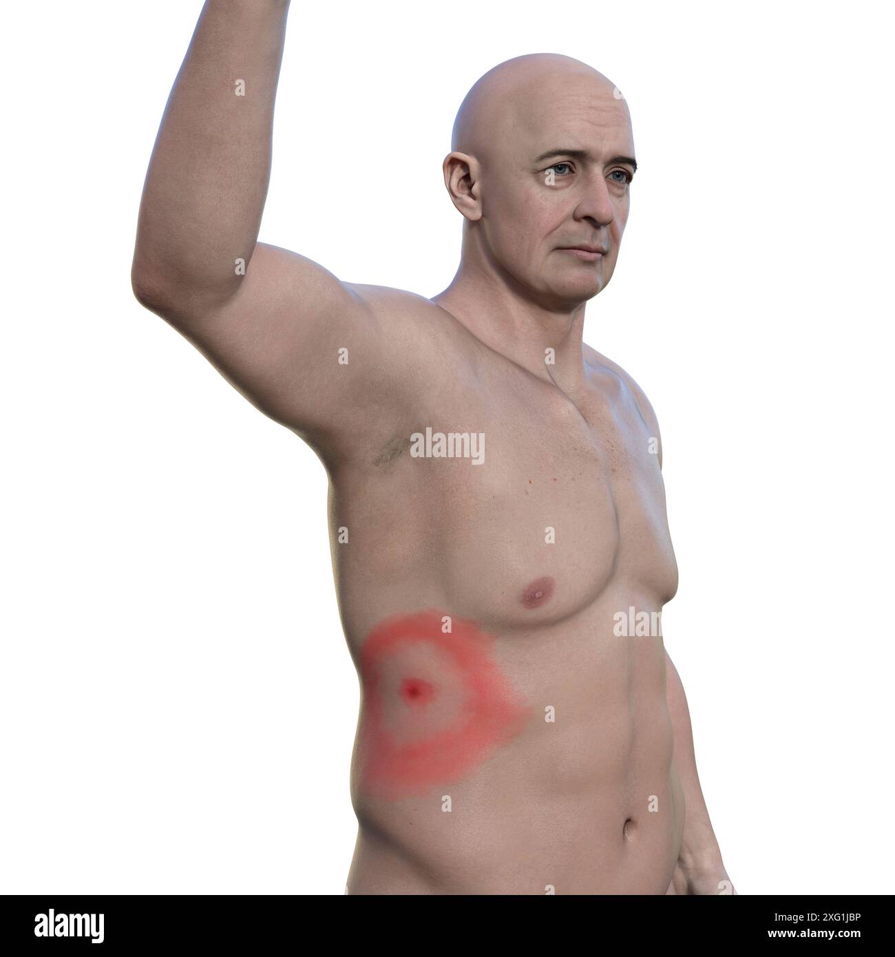 Illustration montrant un érythème migrant, une éruption cutanée ...