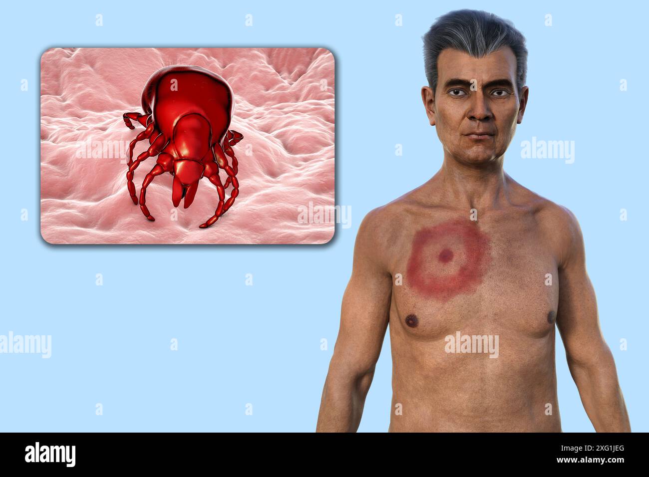 Illustration montrant un érythème migrant, une éruption cutanée ...