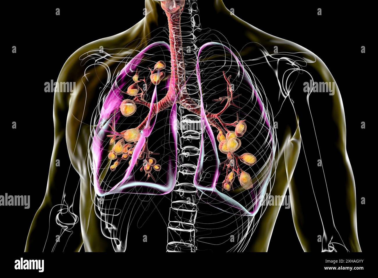 Illustration de poumons atteints de mucoviscidose, une maladie ...