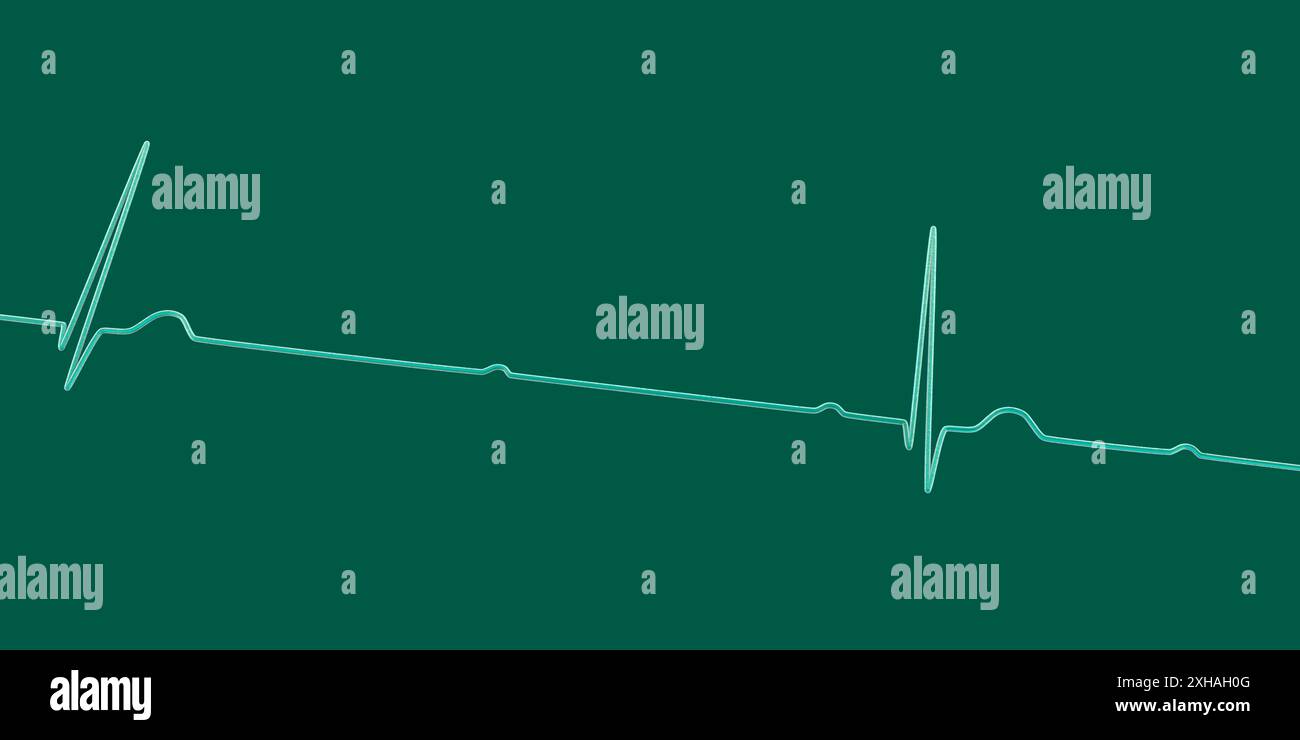 Illustration d'un électrocardiogramme (ECG) représentant un bloc ...