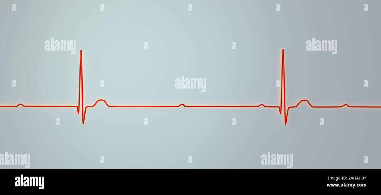 Illustration d'un électrocardiogramme (ECG) représentant un bloc ...