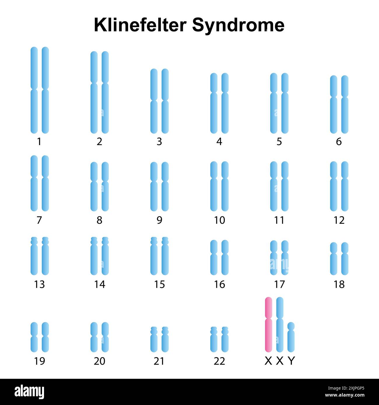 Syndrome de Klinefelter, illustration Photo Stock - Alamy