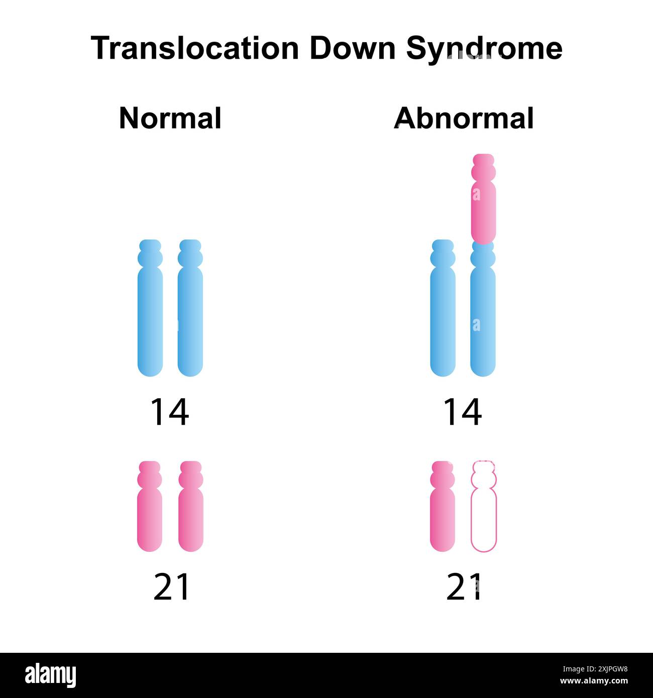 Syndrome De Down Caryotype Banque De Photographies Et Dimages à Haute