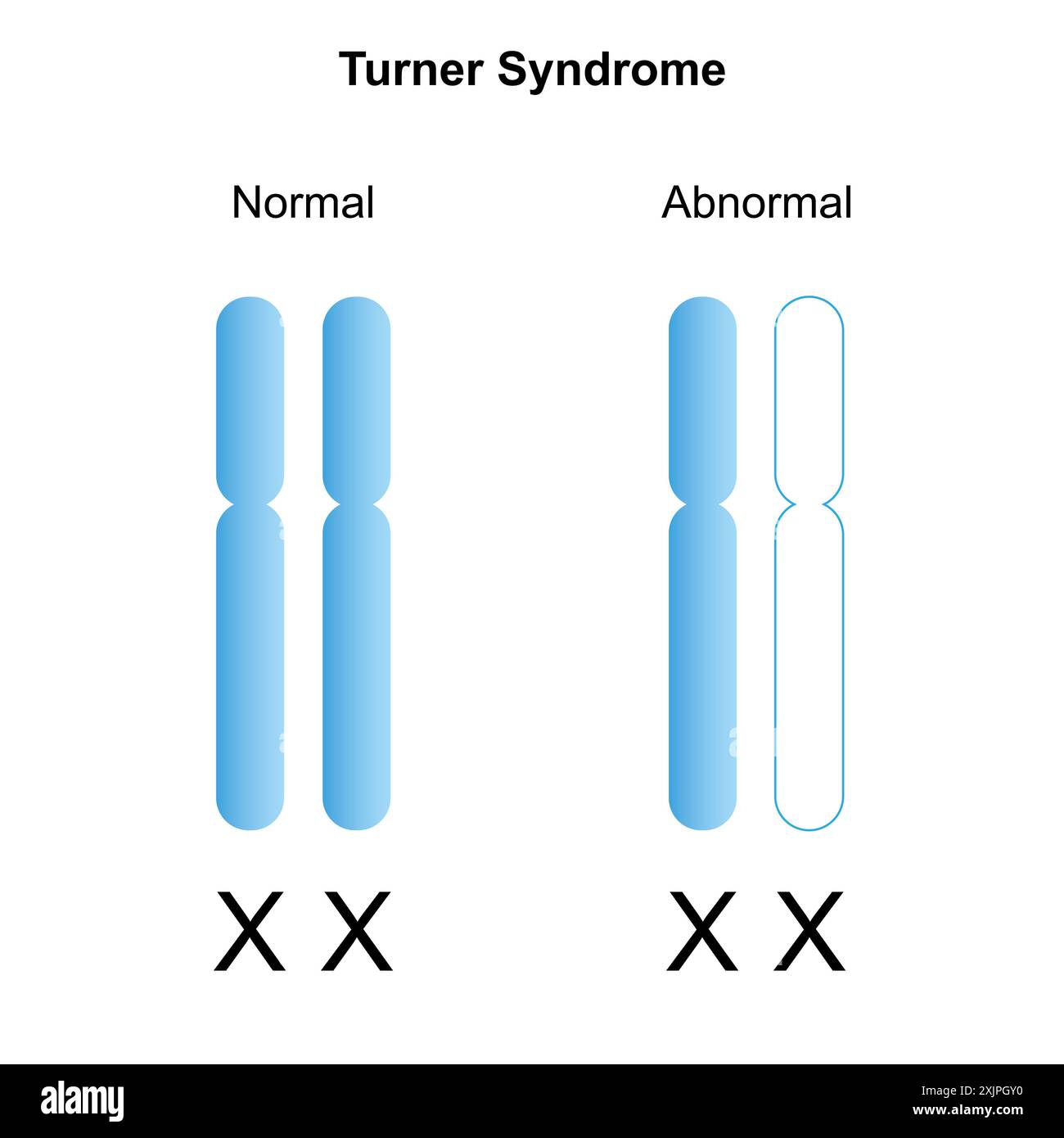 Syndrome De Turner Caryotype Banque De Photographies Et Dimages à