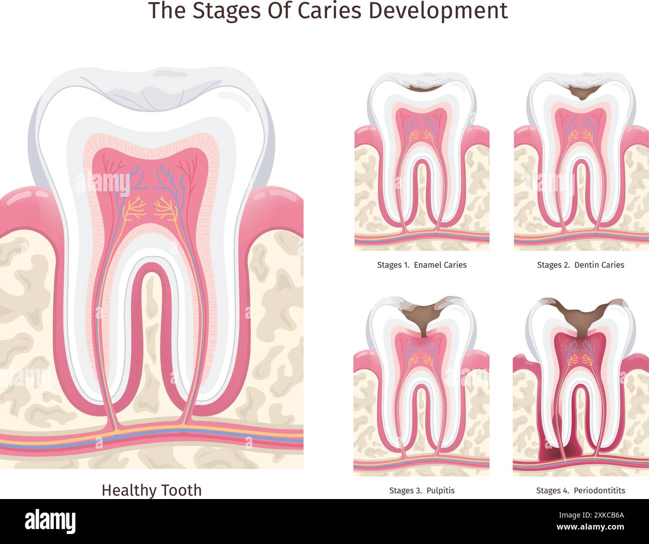Stades de la carie. Progrès des dents de carie humaine, problème ...