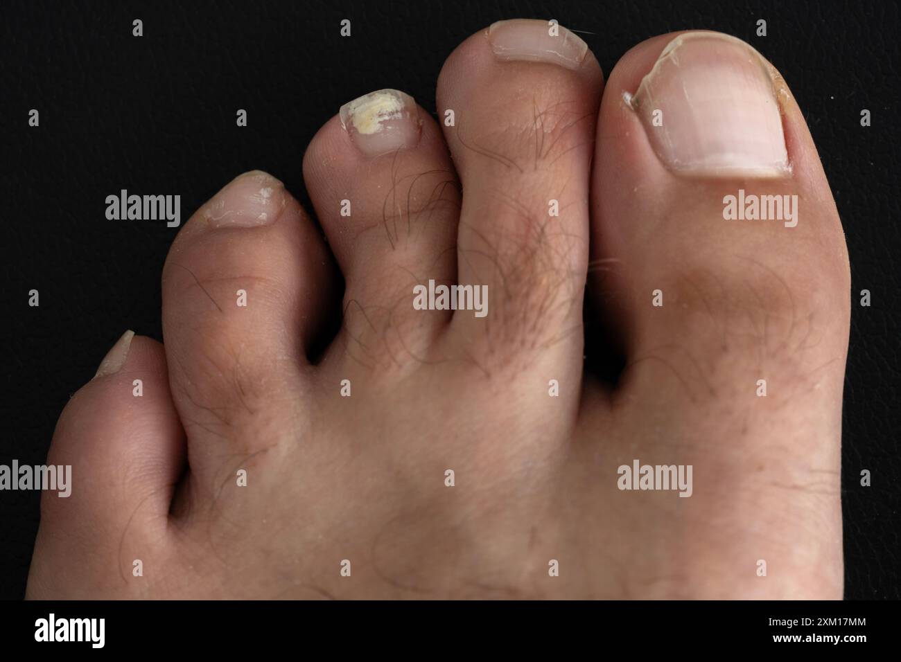 Cancer du pied Banque de photographies et d’images à haute résolution ...