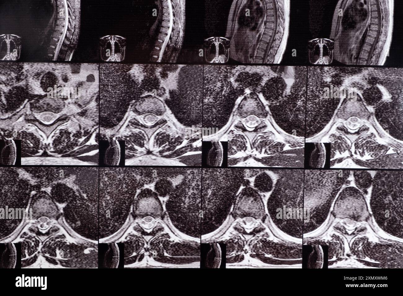 IRM d'un patient présentant une protrusion discale intervertébrale et ...