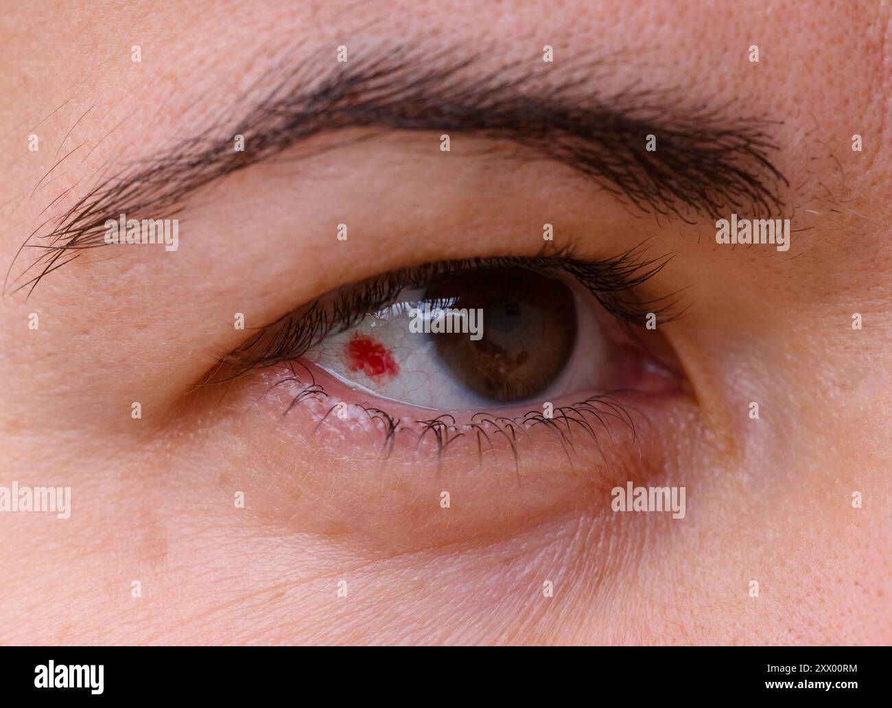 Hémorragie sous conjonctivale Banque de photographies et d’images à ...