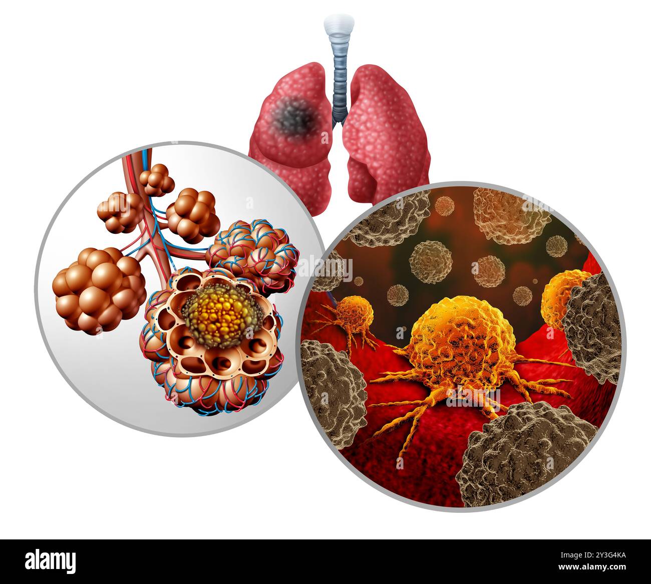 Carcinome alvéolaire cancer du poumon comme alvéoles pulmonaires ou ...