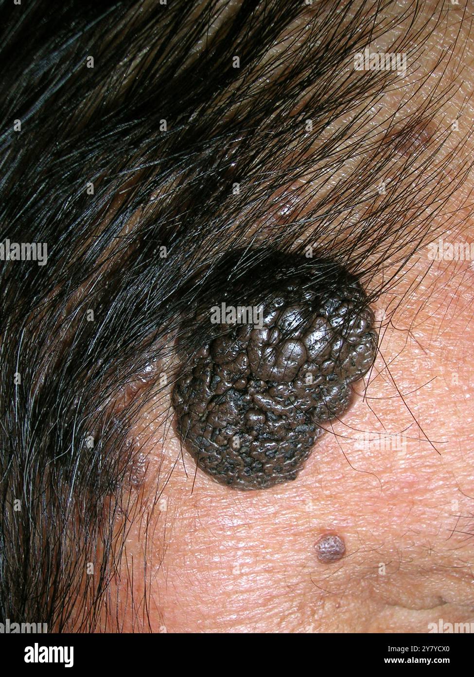 Kératose séborrhéique cébriforme sur le visage d'un malade. Cette ...