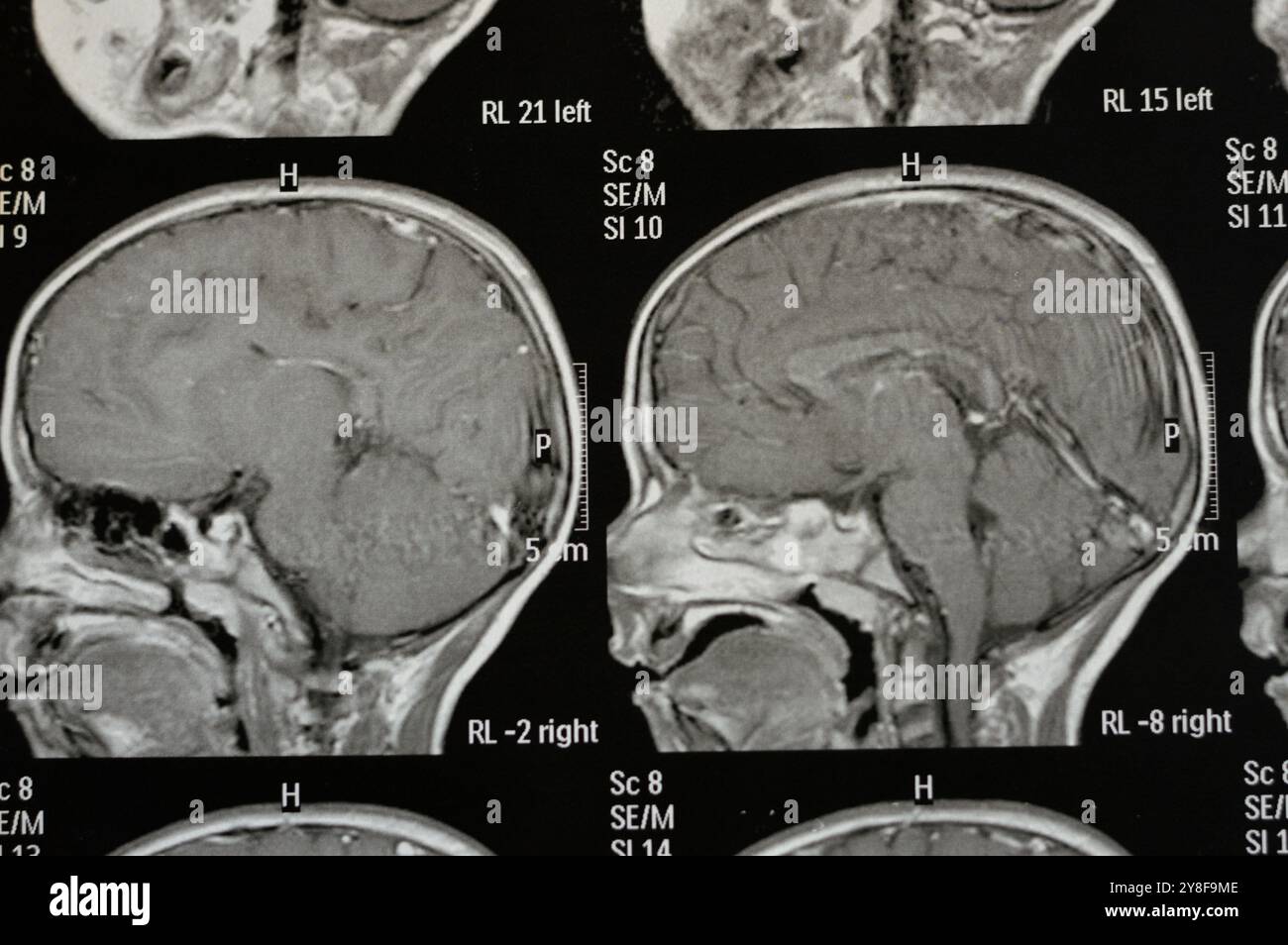L'IRM du cerveau révèle des opérations de shunt antérieures pour un cas ...