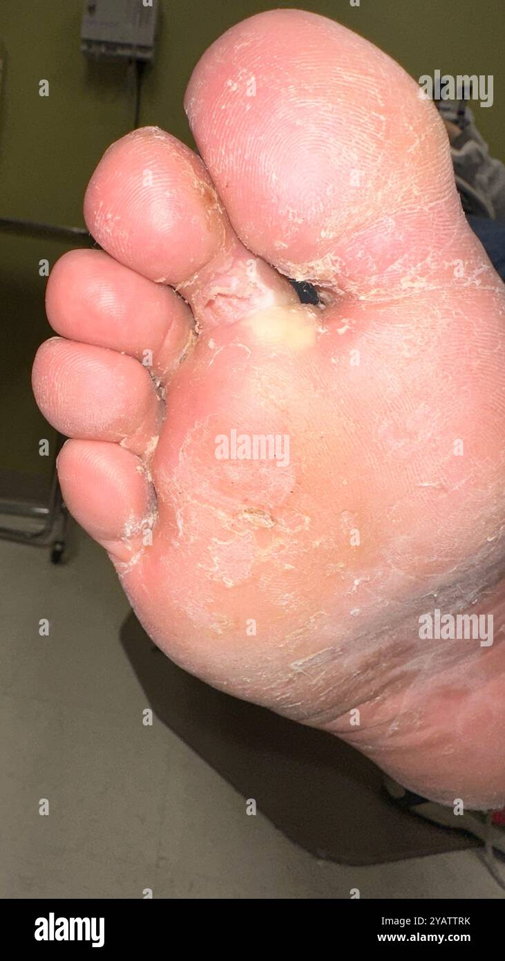 Infection du pied d'athlète. Le pied d'athlète, ou tinea pedis, est une ...