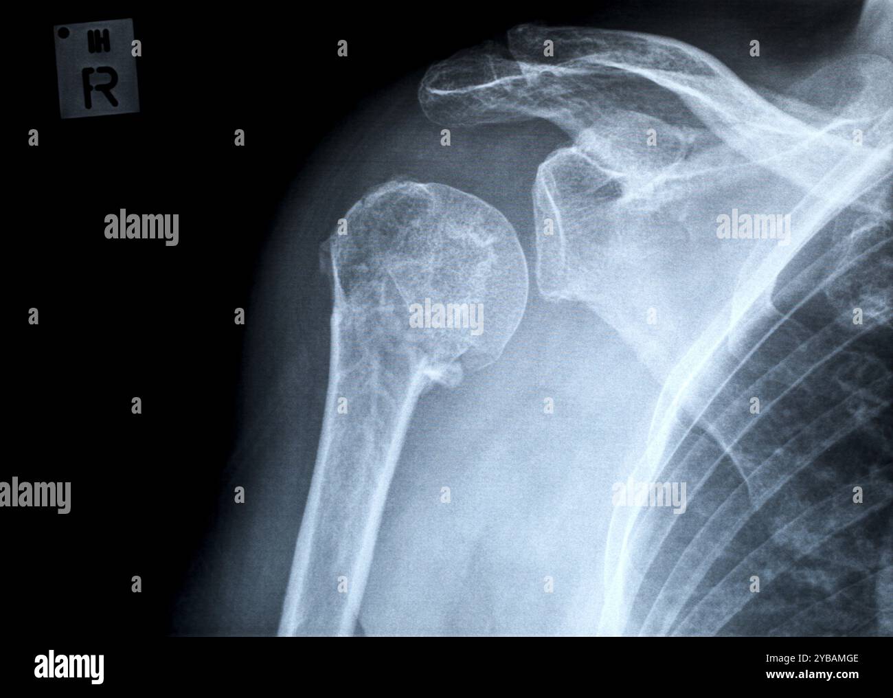 Fracture humérale droite, image antéro-postérieure (ap) à l'aide d'une ...
