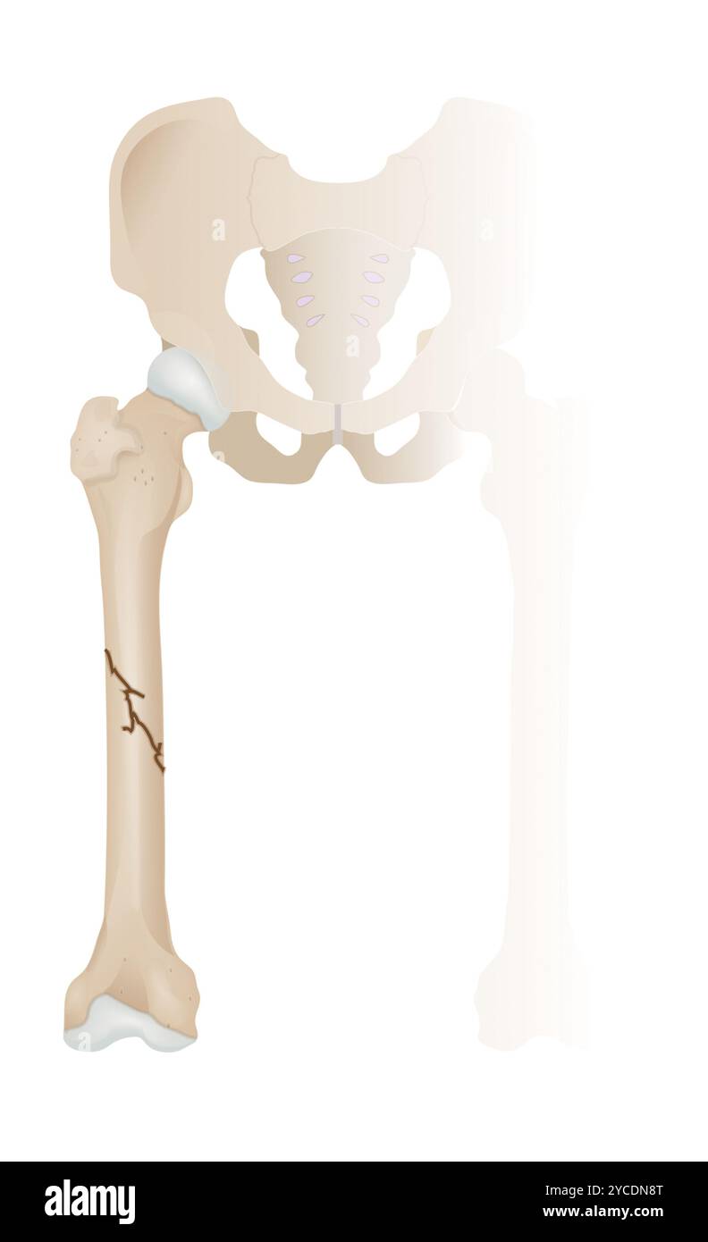 Illustration d'une fracture oblique du fémur. Ce type de fracture se ...