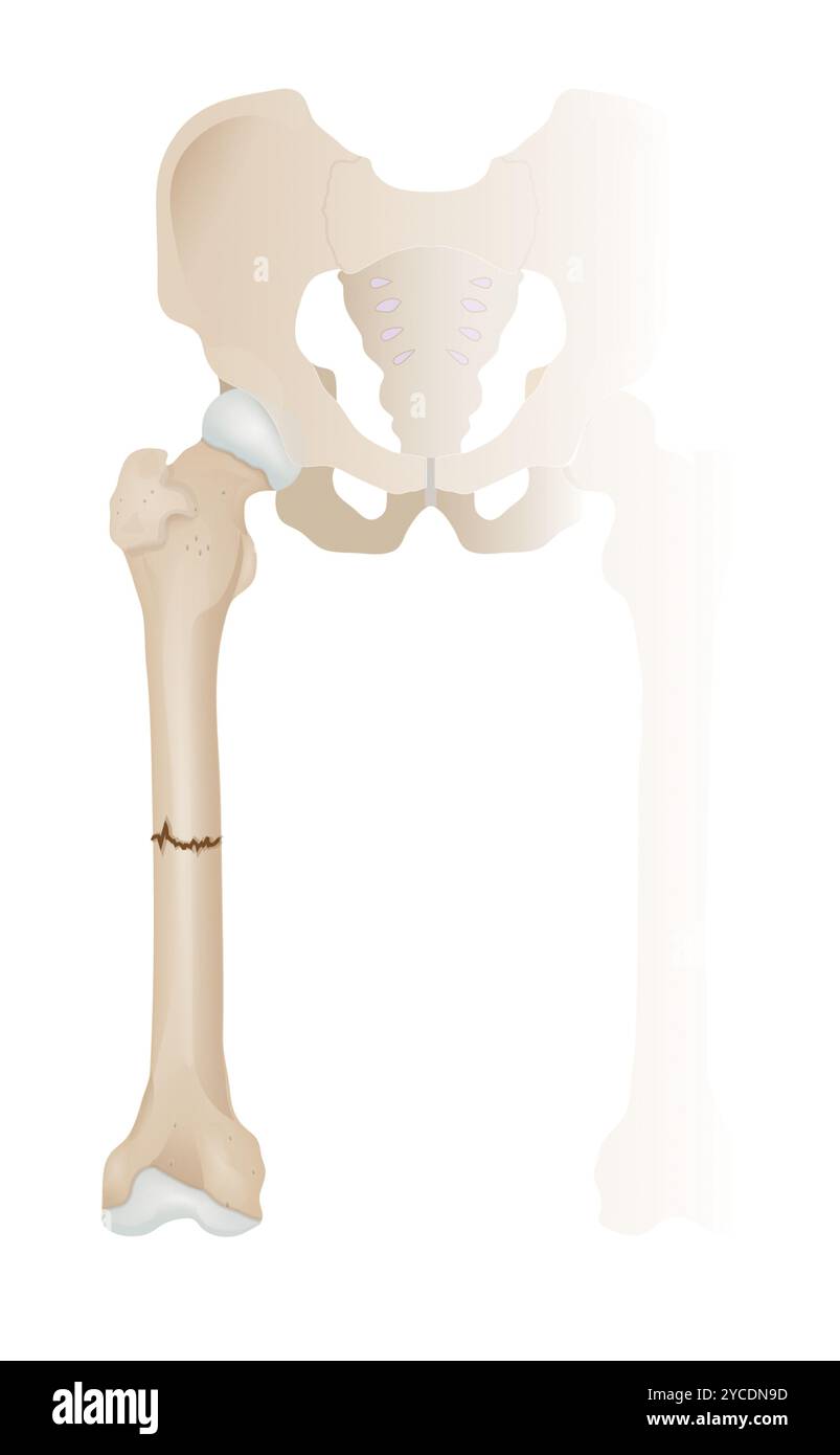 Illustration d'une fracture transversale du fémur. Une fracture ...