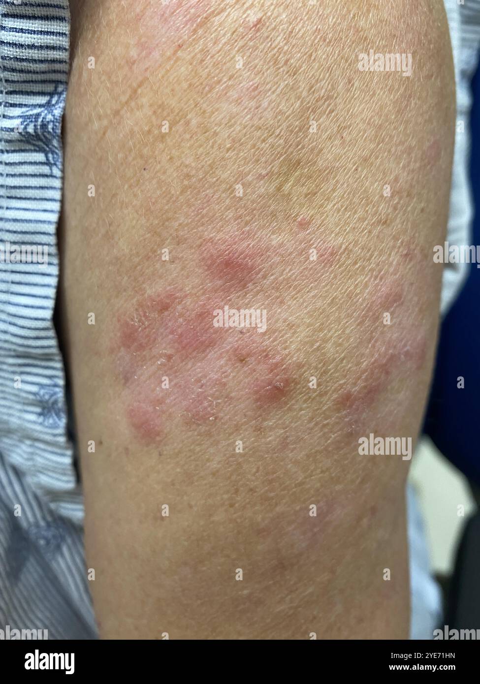 Mycosis fongoïde sur le bras d'un patient. Le mycosis fongoïde est une ...