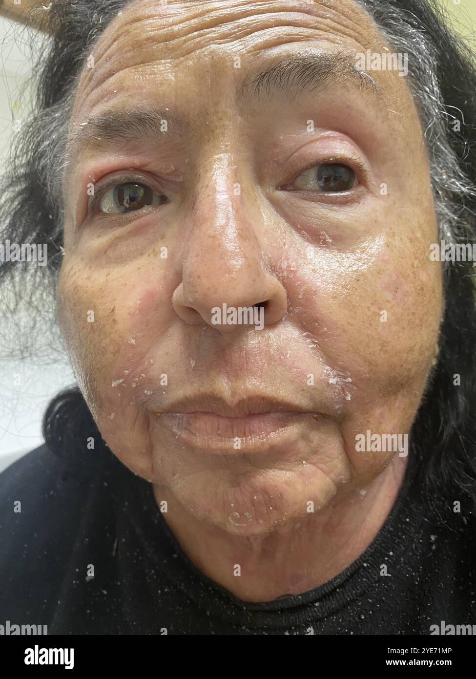 Usage éditorial seulement Sebopsoriasis sur le visage d'un patient. La ...