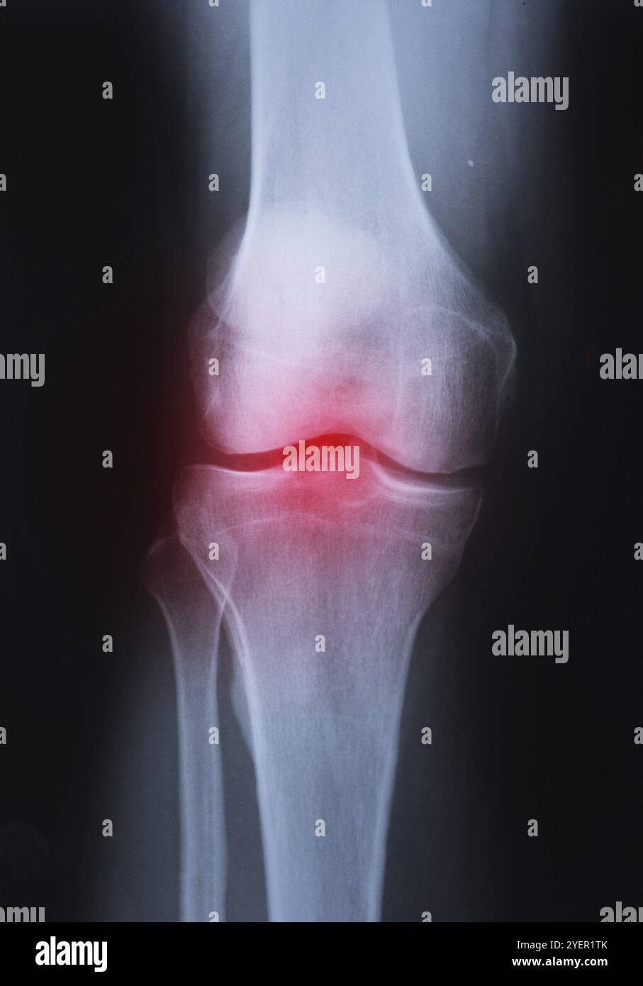 Polyarthrite rhumatoïde du genou Banque de photographies et d’images à ...