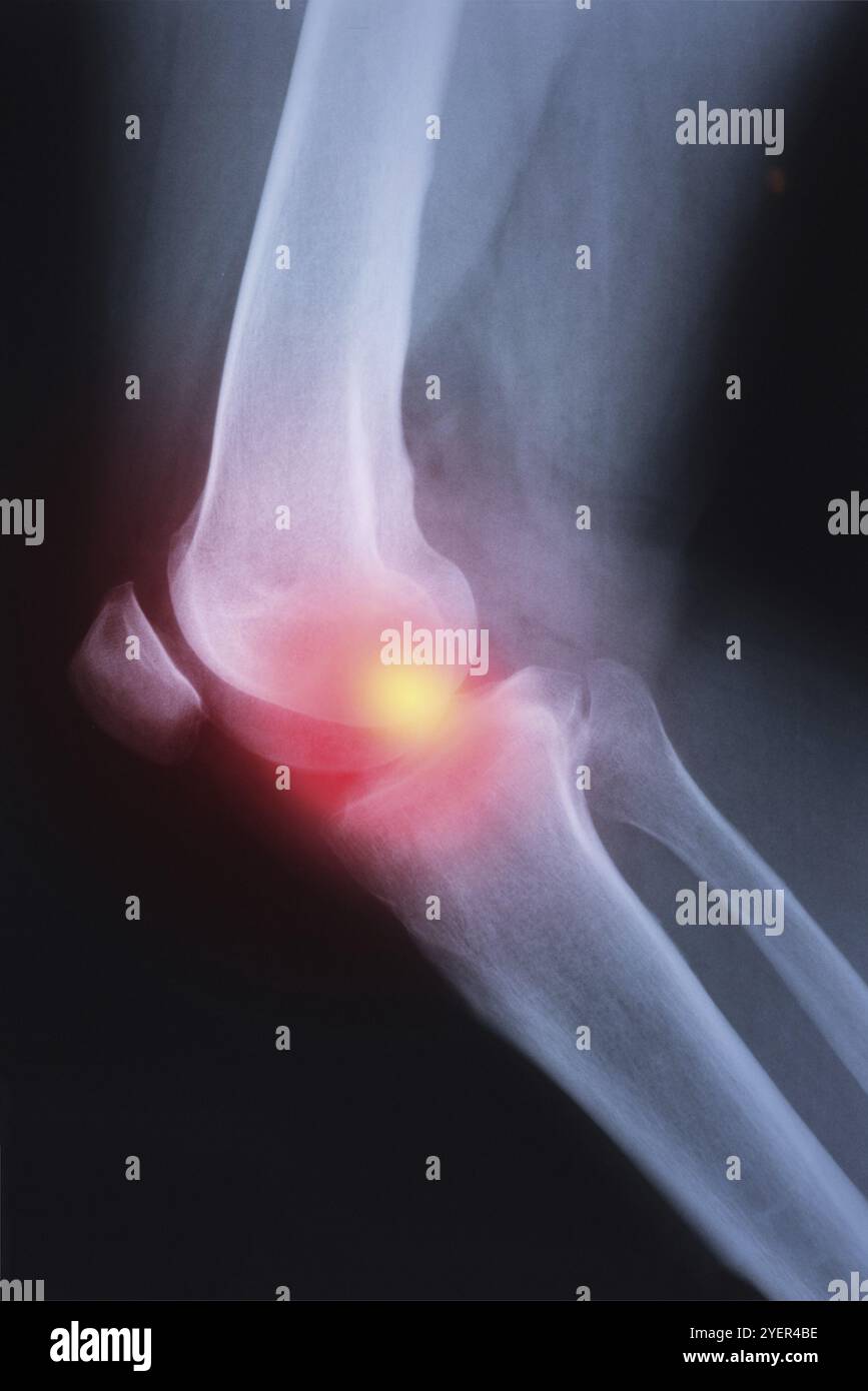 Polyarthrite rhumatoïde du genou Banque de photographies et d’images à ...