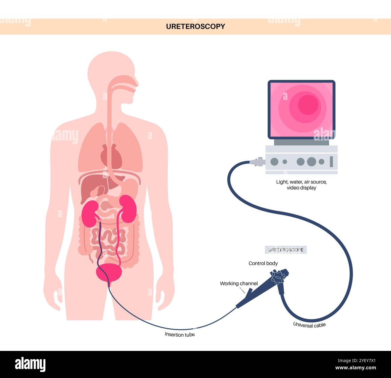 Illustration conceptuelle d'un procédé d'urétéroscopie. Il s'agit d'une procédure effectuée pour ...