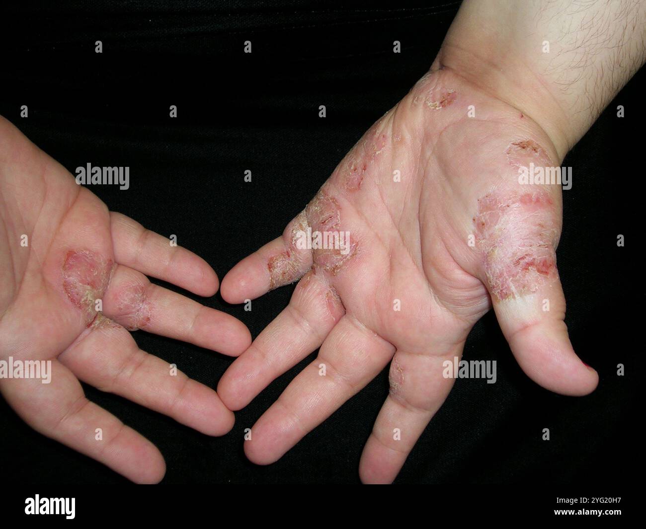 Peau fissurée sur les mains d'une patiente atteinte de dermatite. La ...
