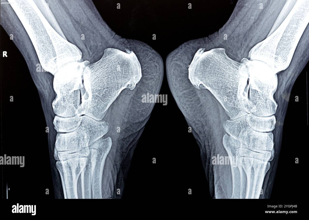Une radiographie simple du pied de la patiente montre l'éperon ...