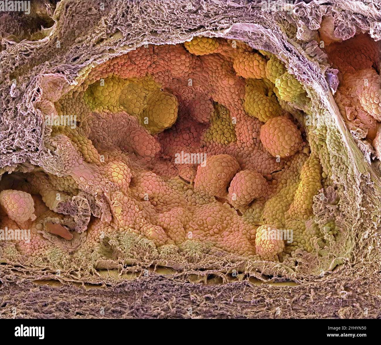 Cancer de la prostate. Micrographie électronique à balayage de gel ...