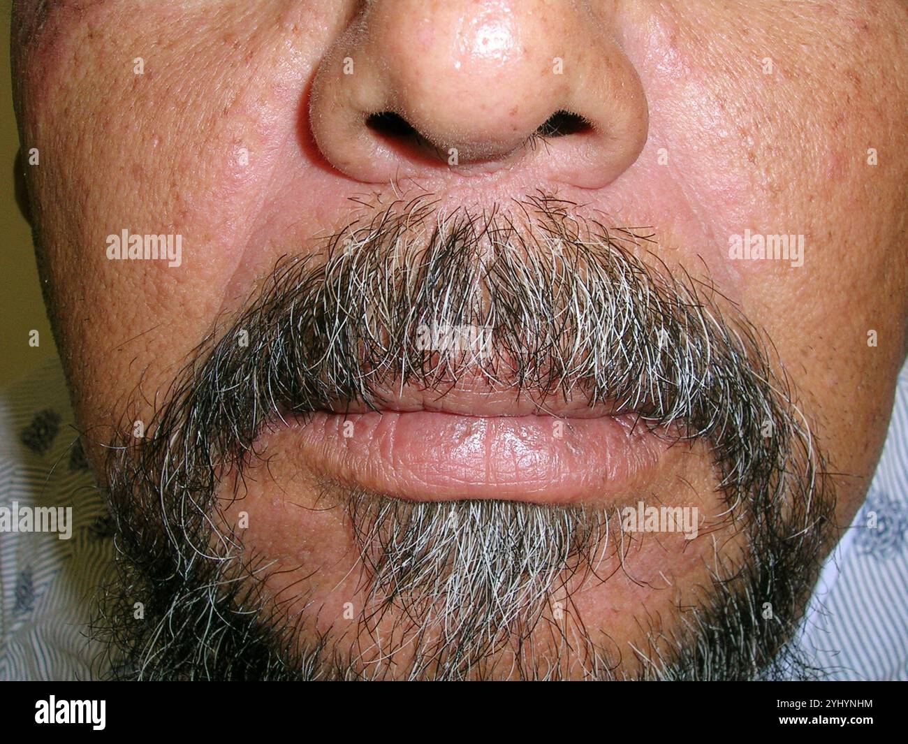 Dermatite séborrhéique dans les plis naso-labiaux d'une patiente. Il s ...