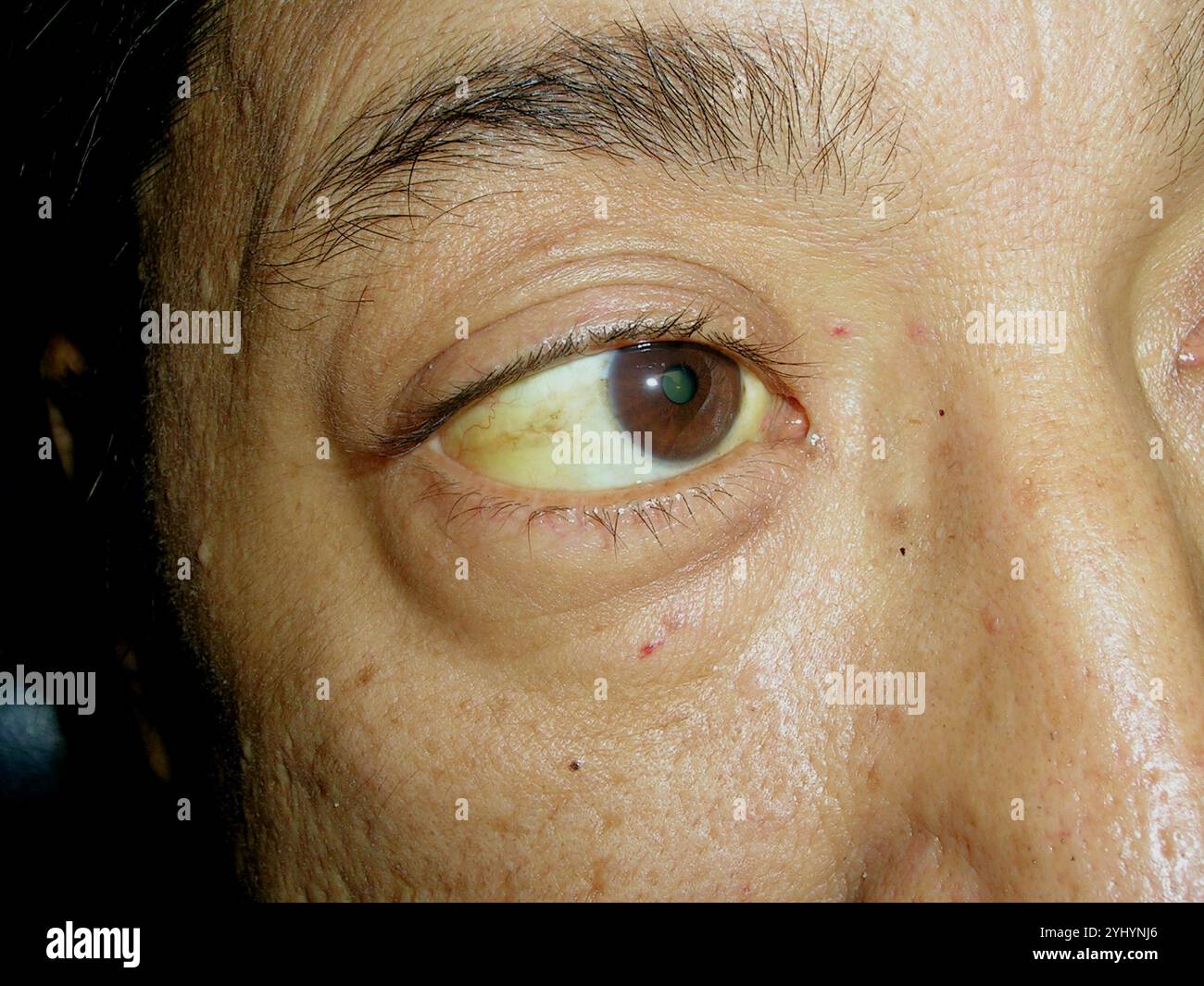 Oeil d'un malade présentant un jaunissement par ictère alcoolique. La jaunisse n'est pas une ...