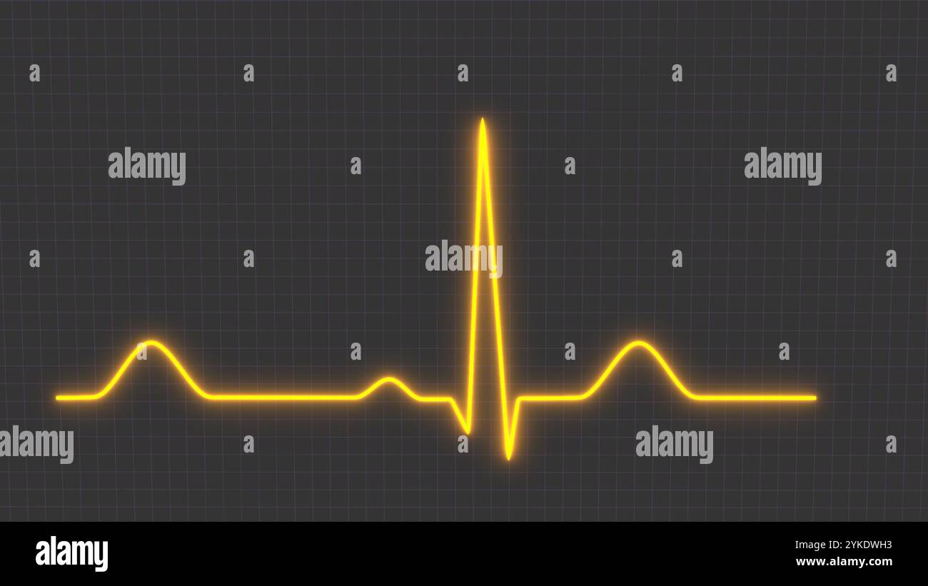ELECTROCARDIOGRAMME ECG de rythme cardiaque normal d'une personne saine ...