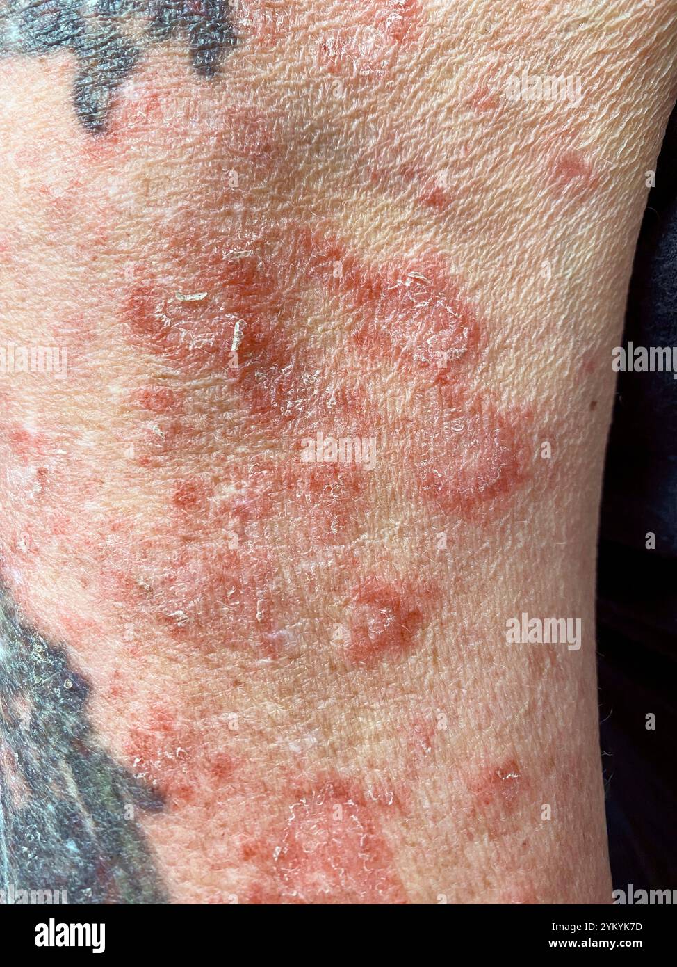 Psoriasis sur la peau d'un patient. Le psoriasis est une affection ...