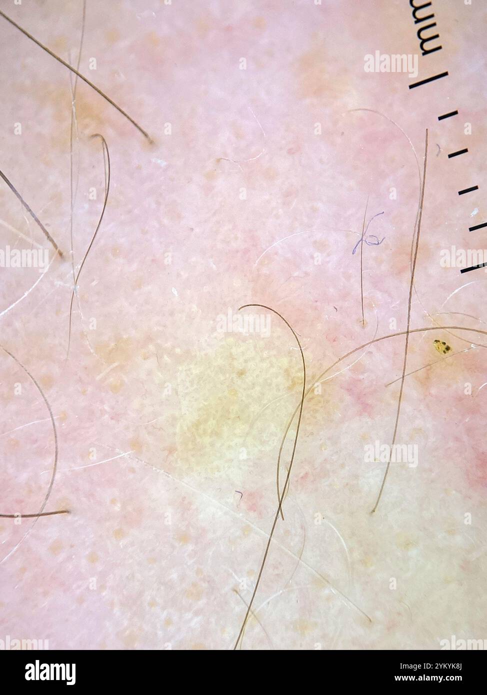 Image dermatoscopique d'une kératose séborrhéique sur le cuir chevelu d ...