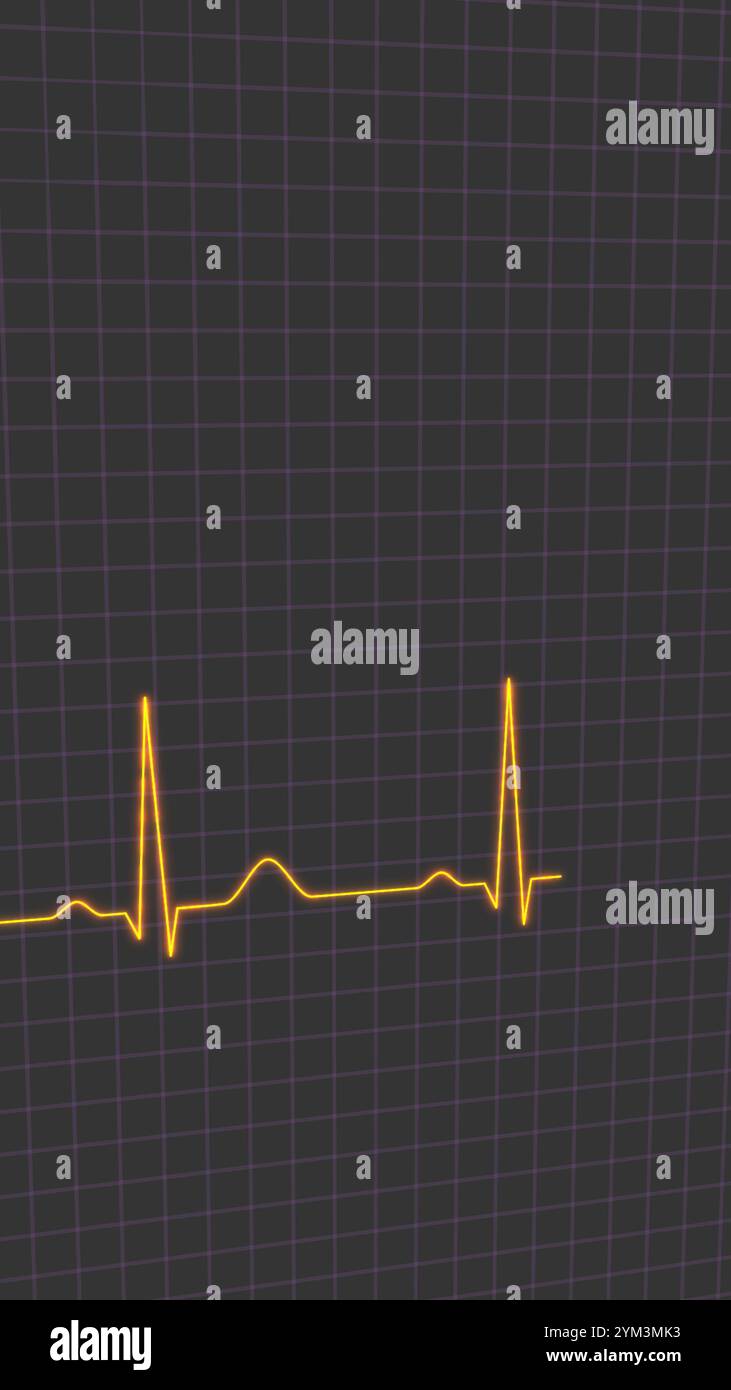 ELECTROCARDIOGRAMME ECG de rythme cardiaque normal d'une personne saine ...
