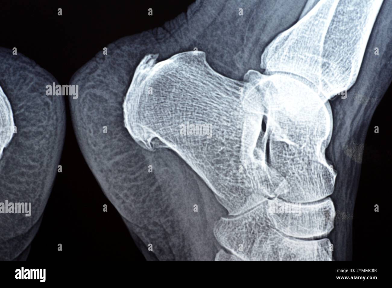 Une radiographie simple du pied de la patiente montre l'éperon ...