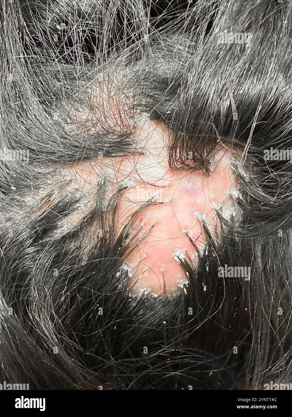 Cuir chevelu d'une jeune femme atteinte de folliculite décalvante ...