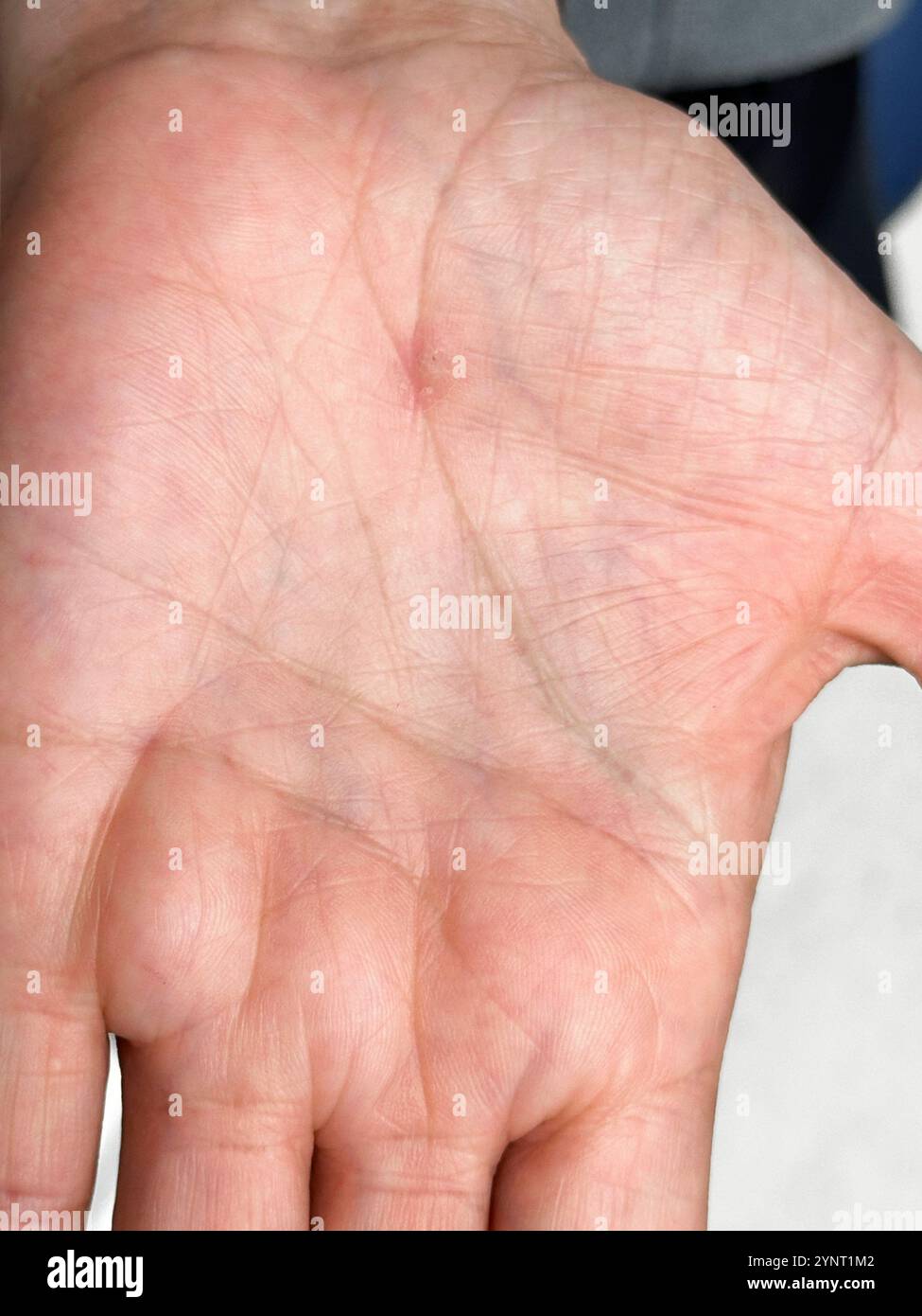 Plaie cicatrisée sur la main d'un patient qui a subi l'ablation d'un ...