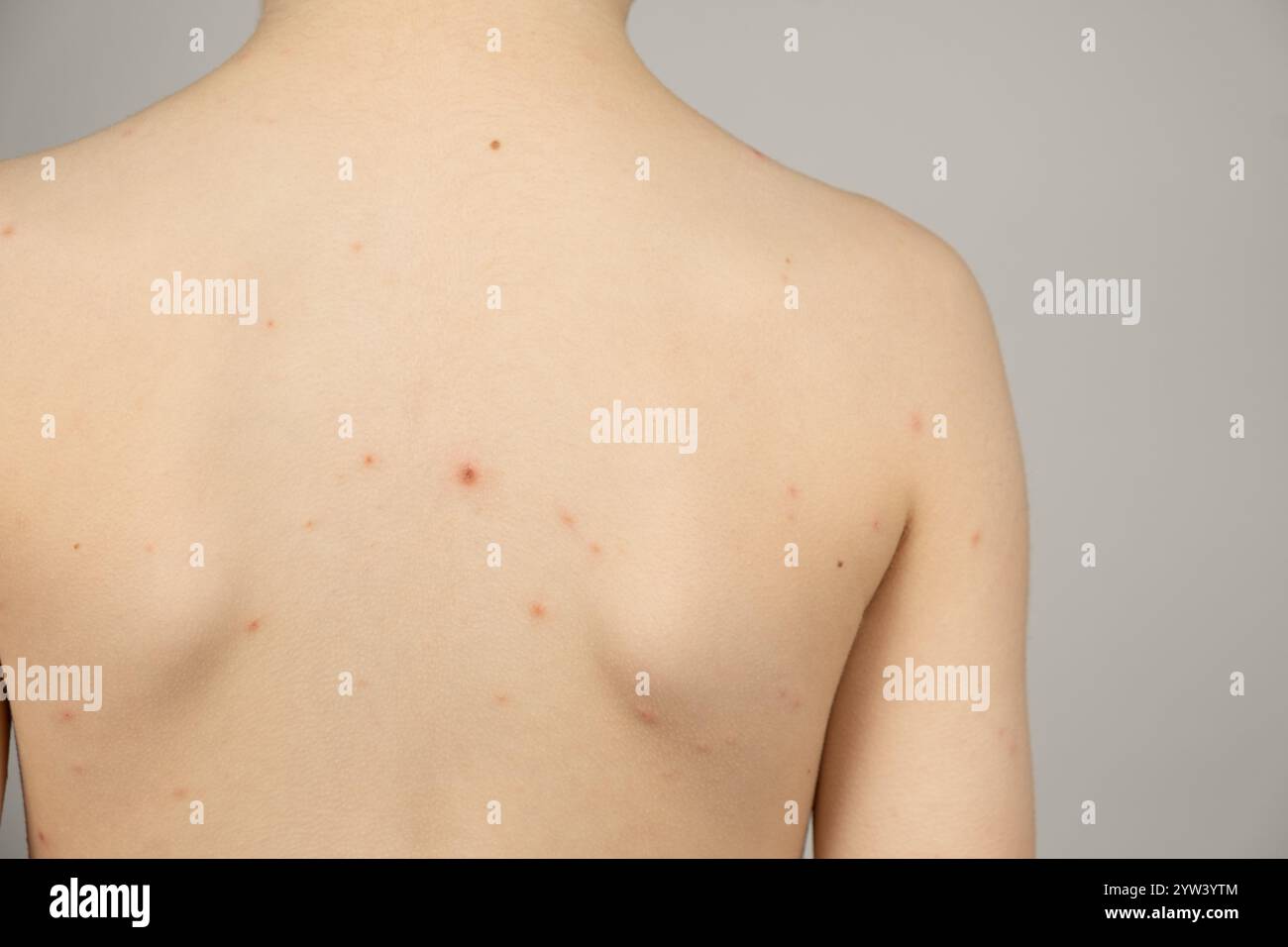 La peau d'un enfant atteint de varicelle, vésicules à différents stades ...