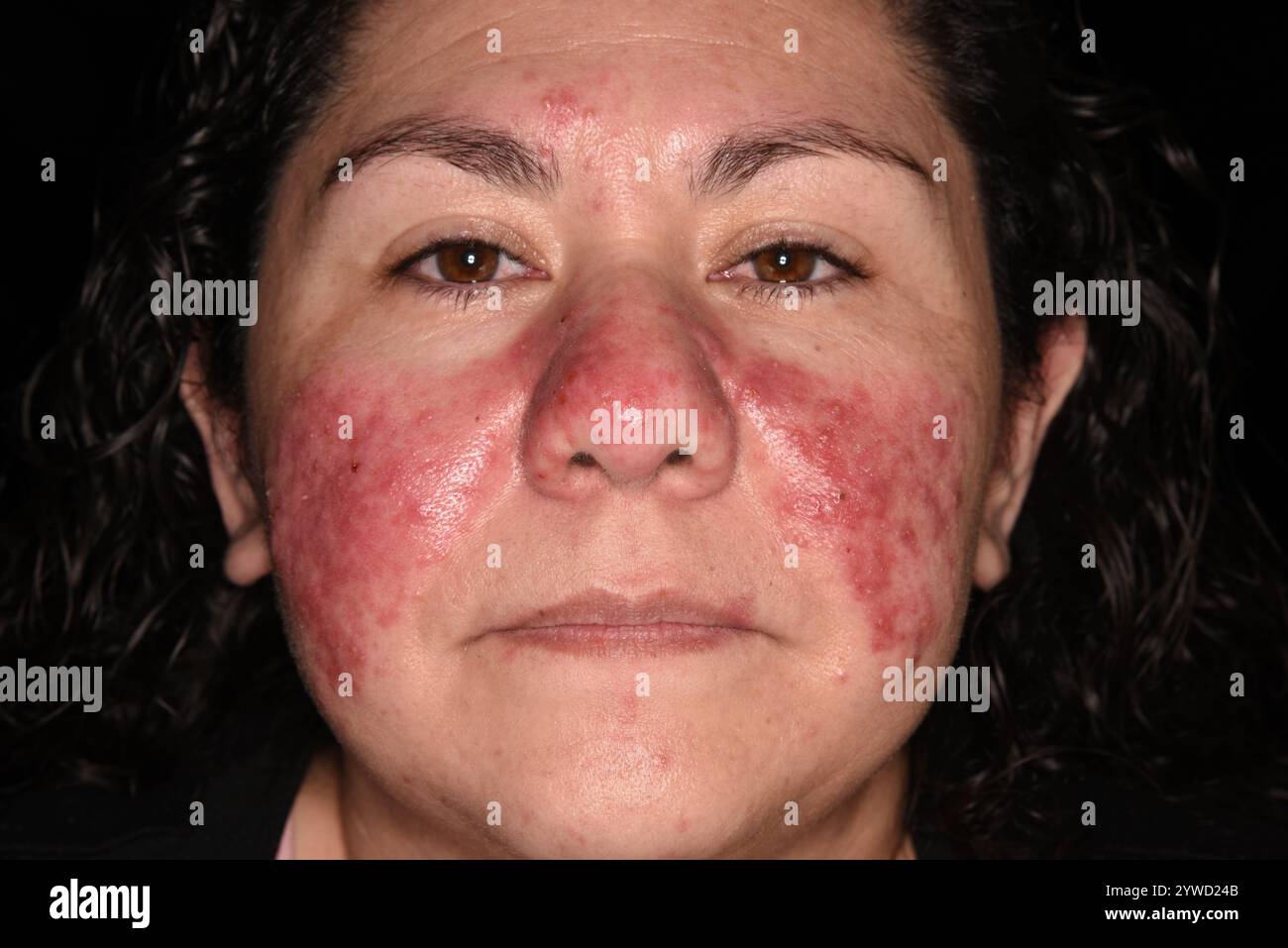 Rosacée sur le visage d'une patiente qui s'est aggravée après ...