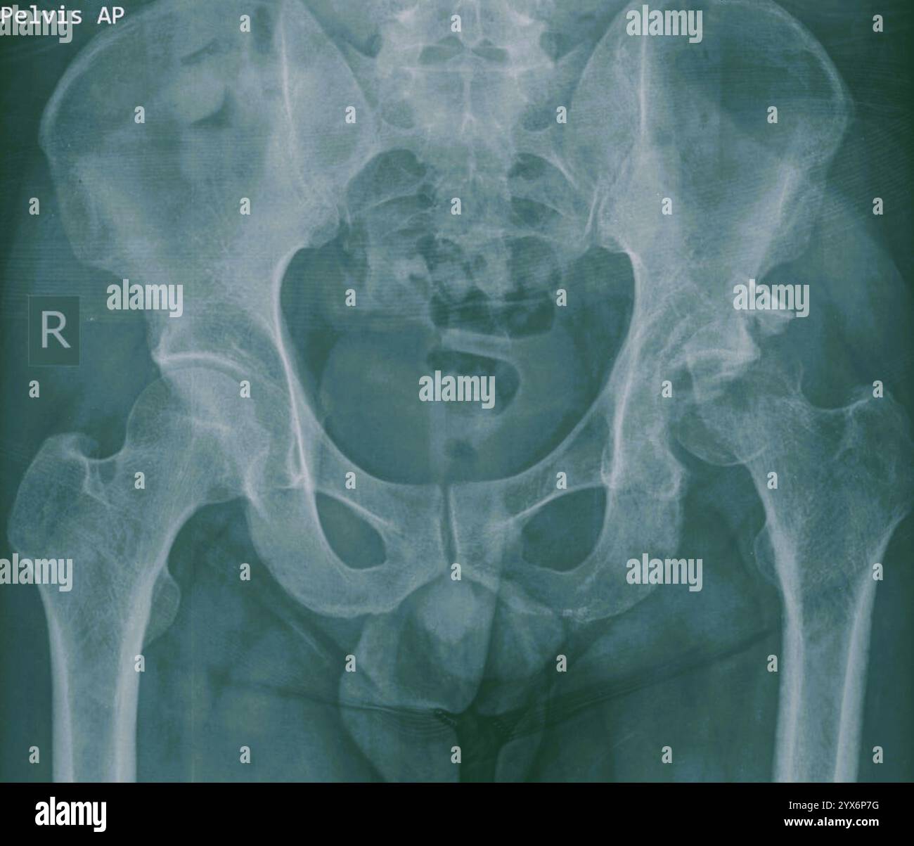 Radiographie du bassin d'un patient atteint d'une fracture du cotyle (blanc, droite). Le cotyle ...