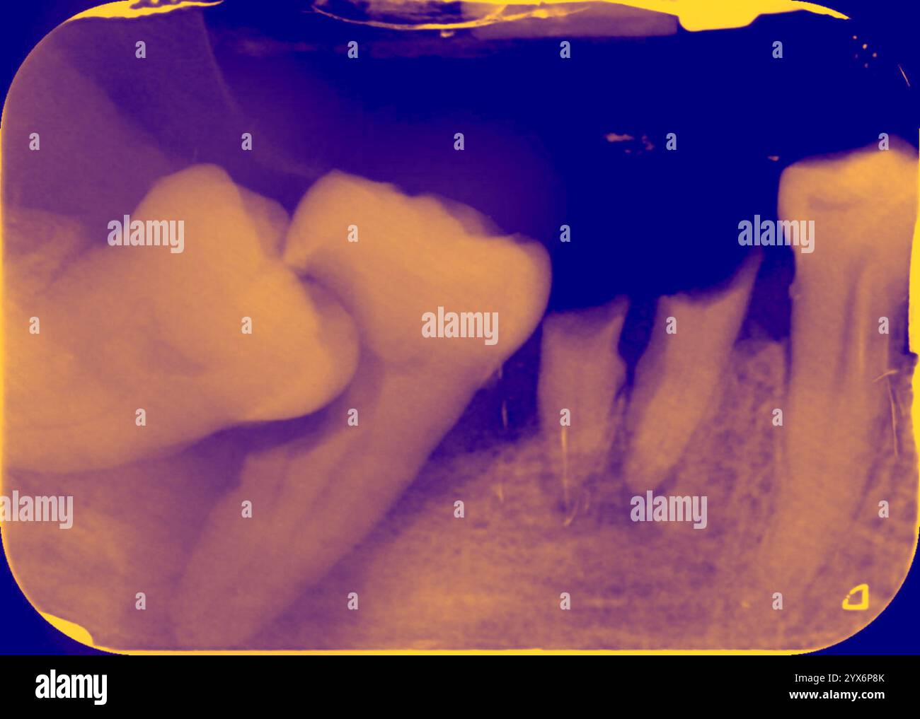 Radiographie périapicale colorée d'une dent de sagesse inférieure ...
