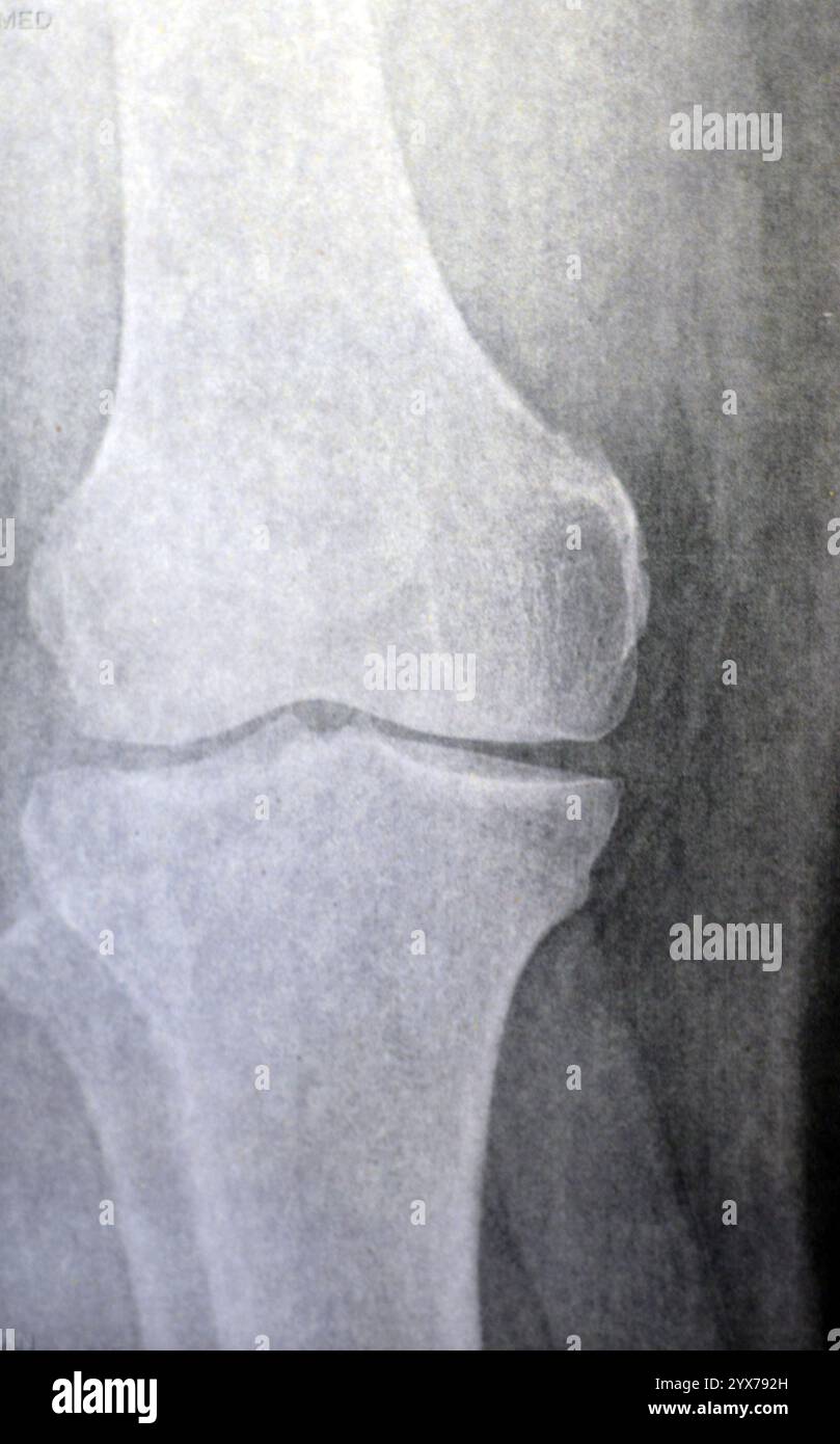 Radiographie simple du genou montrant une arthrose apparente selon le ...