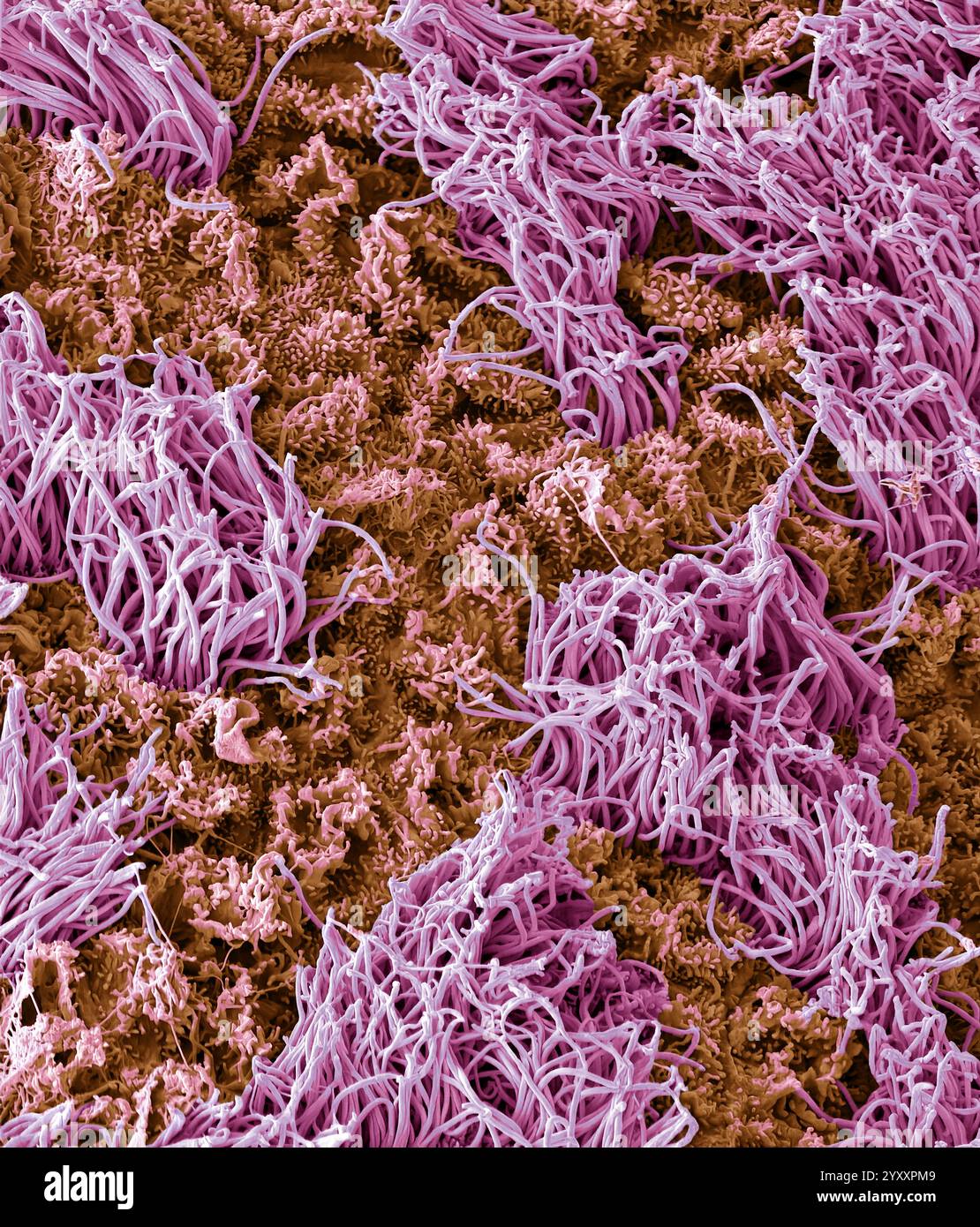 Cancer utérin. Micrographie électronique à balayage couleur (MEB) de l ...